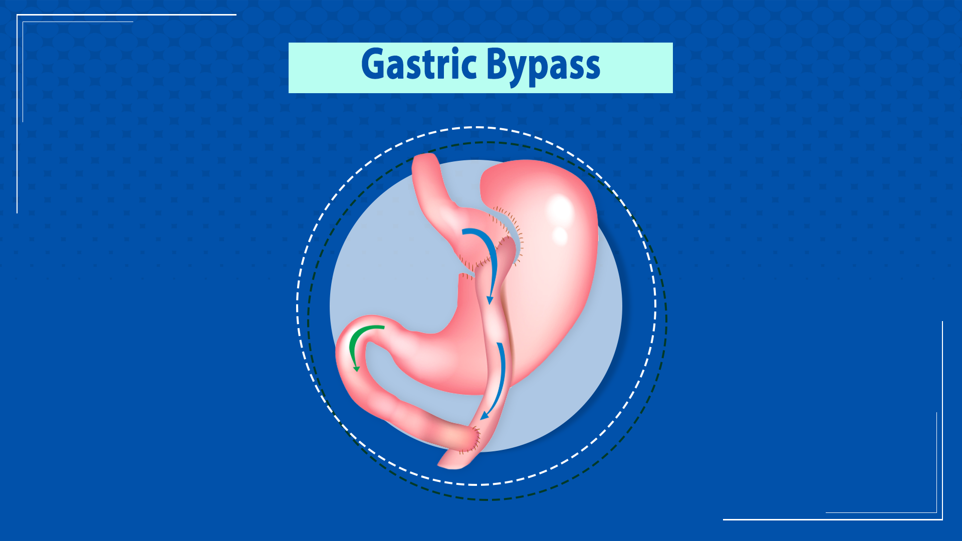 Experience with the SASI Process